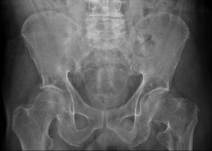 Fratura do Colo do Fémur - Anca & Bacia | Hip & Pelvis