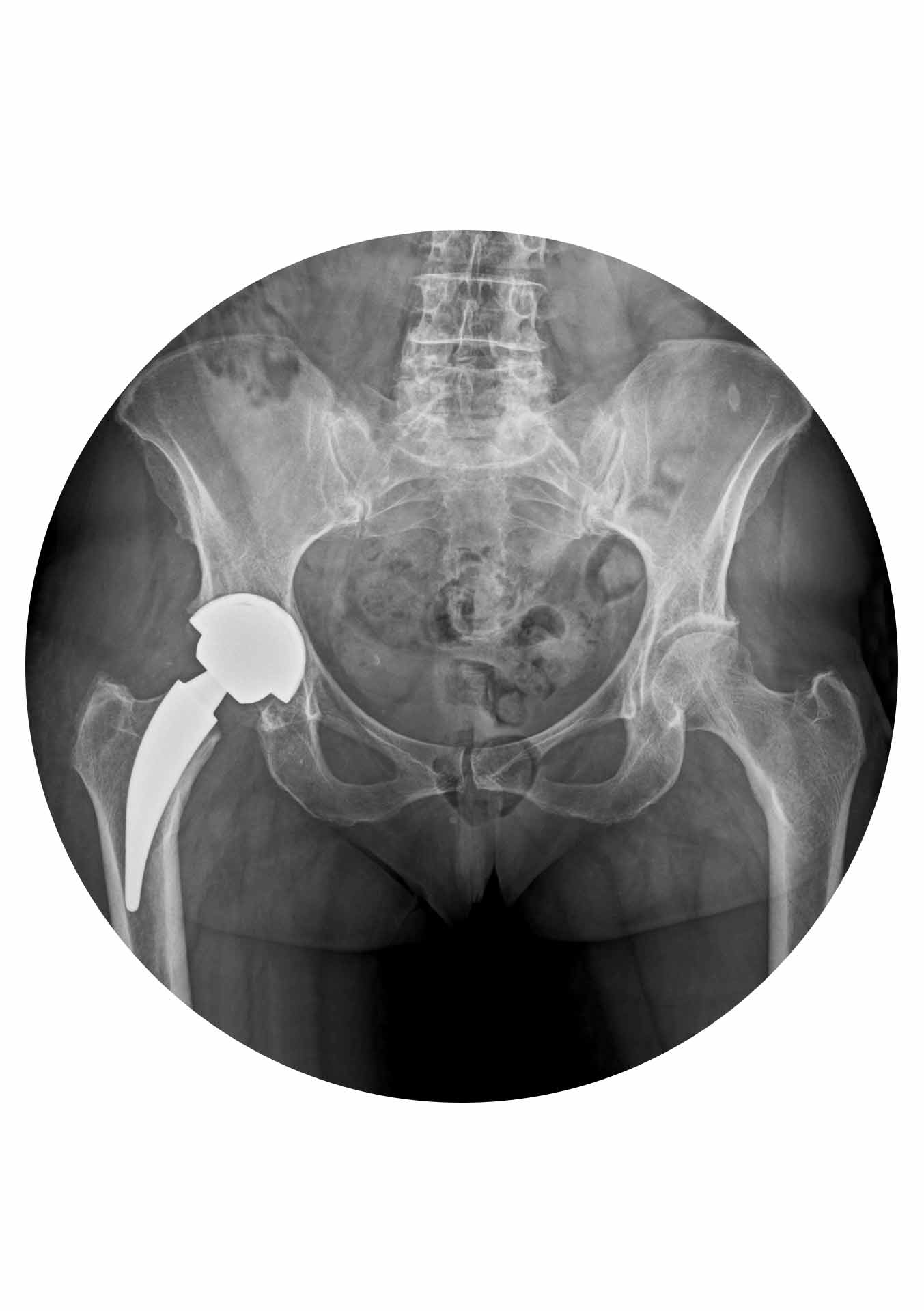 Artroplastia Total da Anca via Biquíni - Anca & Bacia | Hip & Pelvis