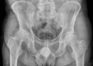 Fratura da Cabeça do Fémur - Anca & Bacia | Hip & Pelvis